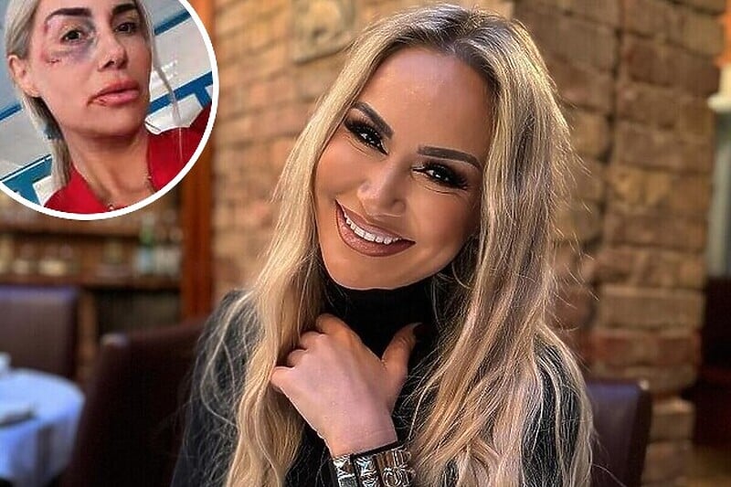 Selma Bajrami javila se iz tuzlanske bolnice i pokazala modrice na oku ...