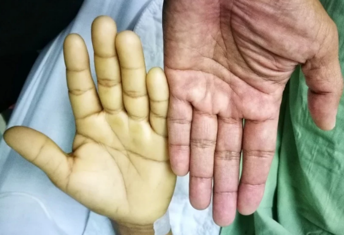 Koji su znakovi anemije i kako je liječiti prirodnim putem