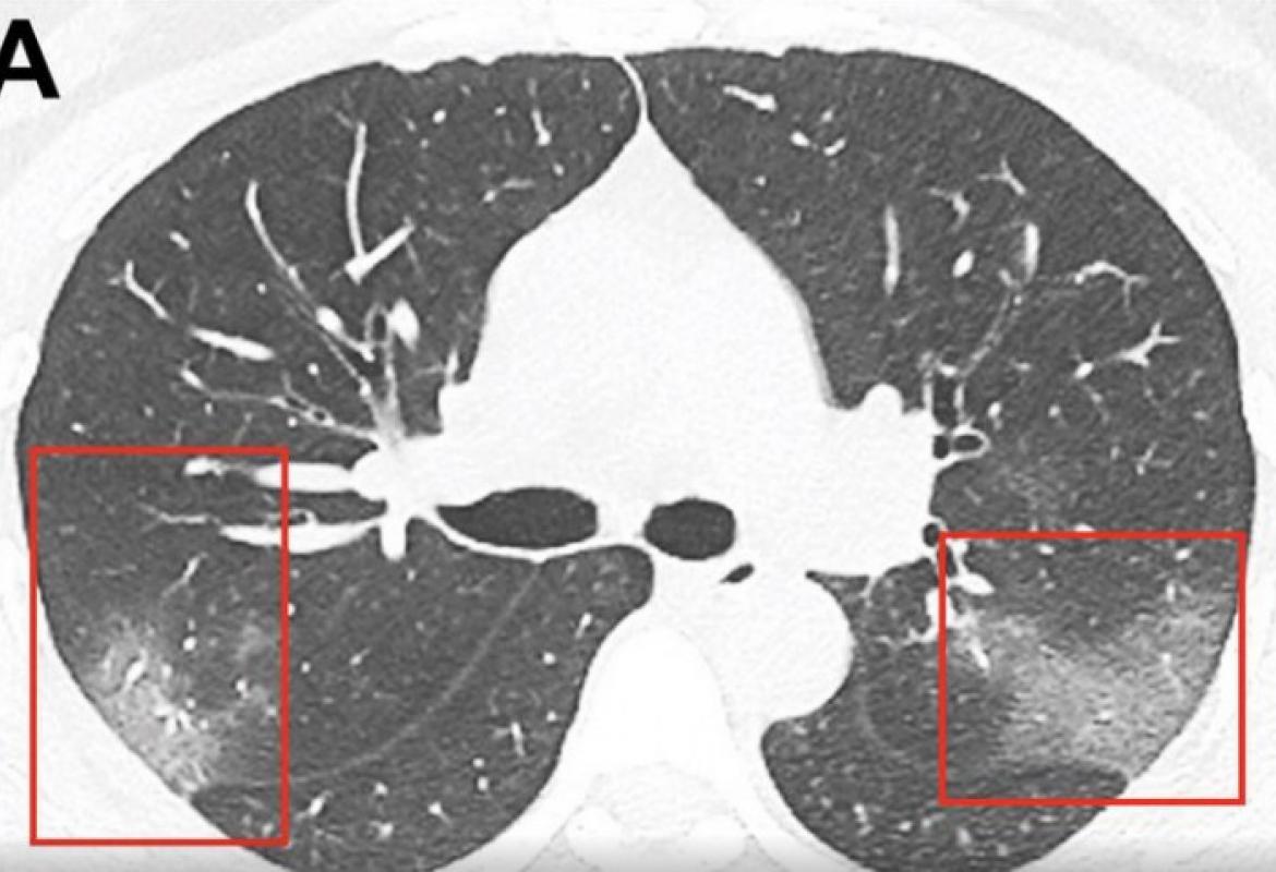 Objavljen CT snimak: Ljekari pokazali šta koronavirus radi ljudskim plućima
