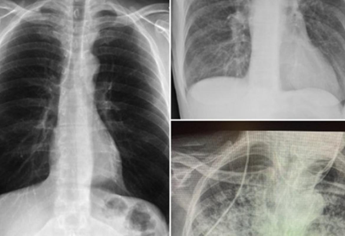 Usporedila pluća pušača i pacijenta koji je prebolio koronu: Ovo je užas