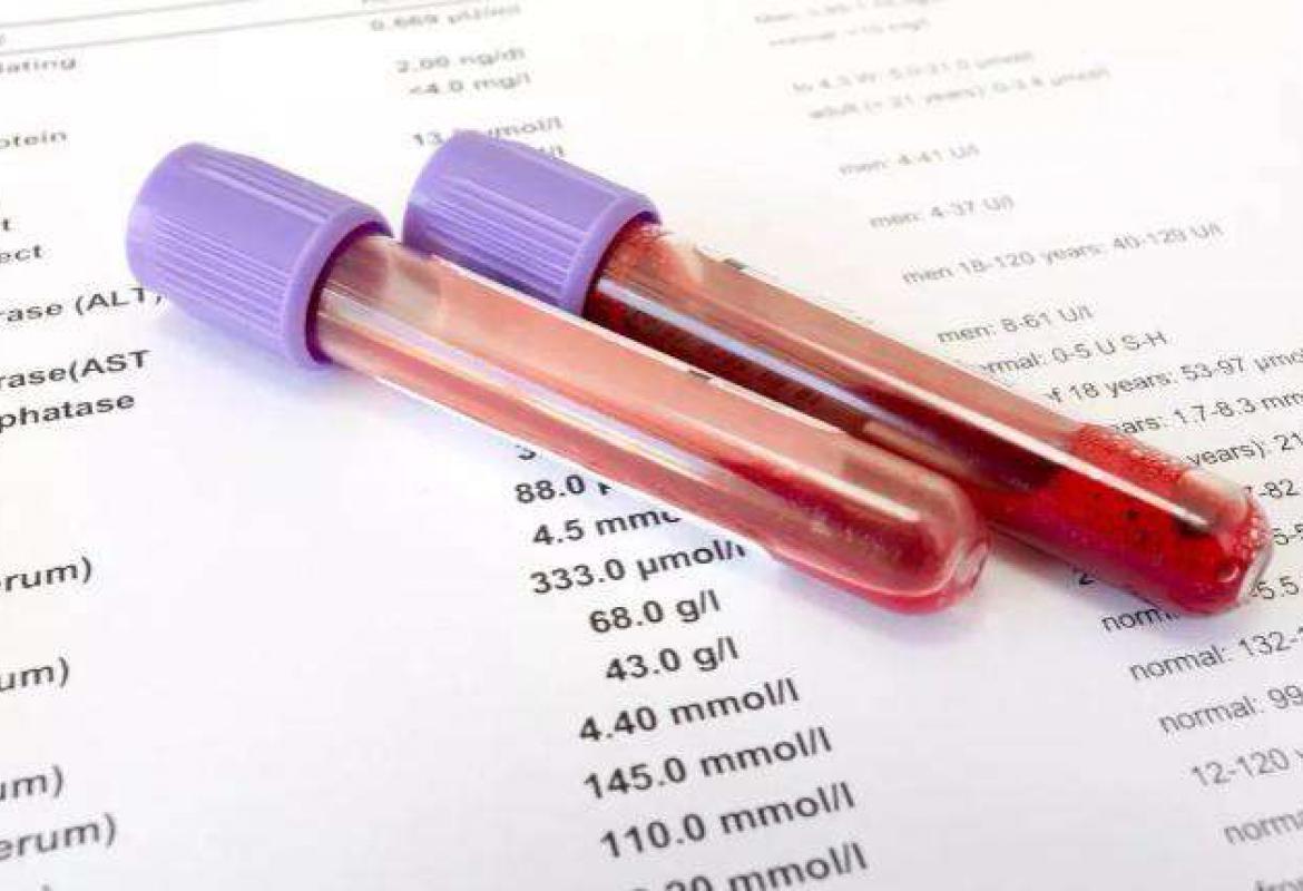 Kompletna krvna slika: Šta znače kratice na nalazu i šta brojke ...