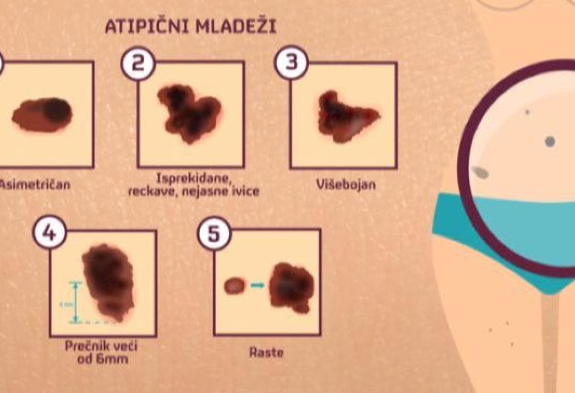 Znate li kako prepoznati promjene na mladežu: Evo kada trebate ...