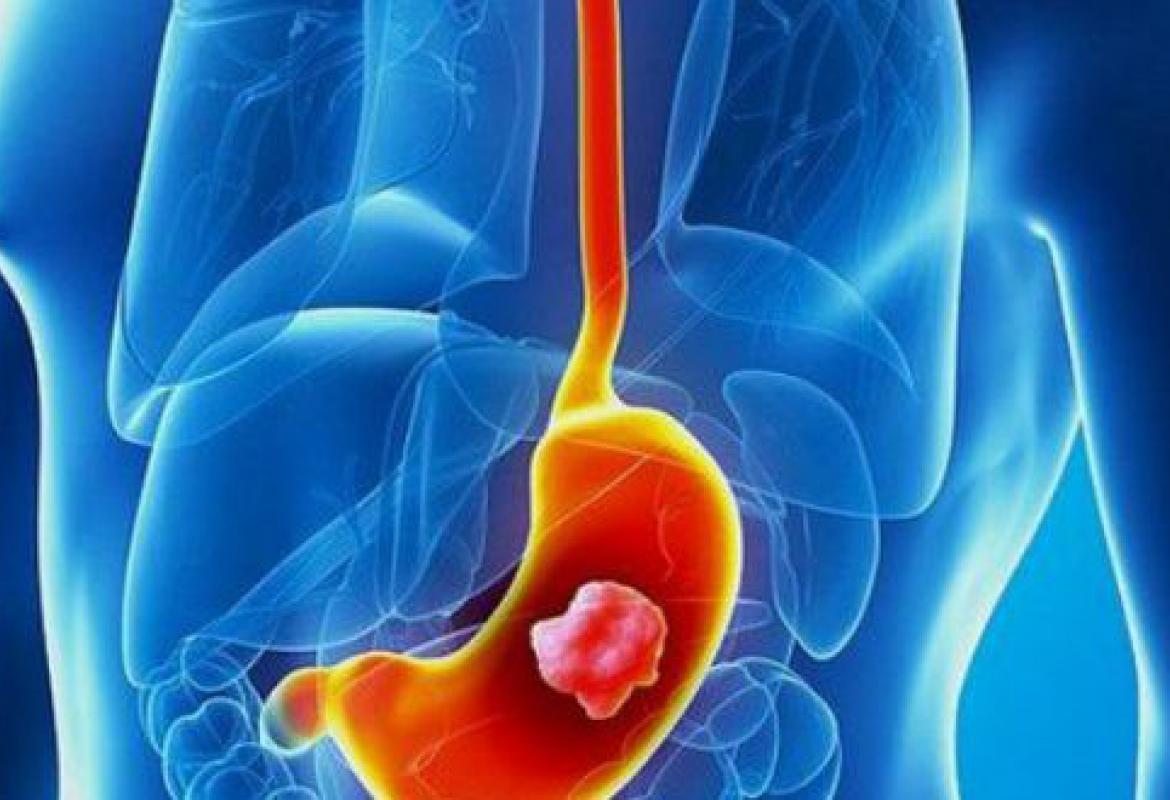 Ovo su znakovi da se u stomaku razvija opasan tumor: Evo koji simptomi ...